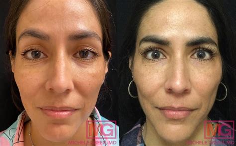 Juvederm Cheek Fillers Juvederm Voluma For Cheeks Dr Michele Green M D