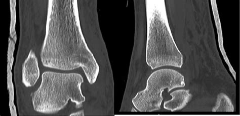 Figure 1 From Closed Posterior Ankle Dislocation Without Associated Fractures A Case Report