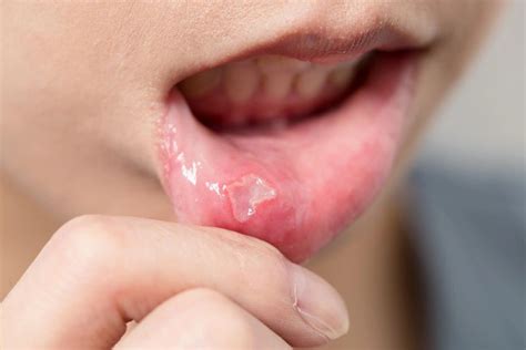 Mouth Lip Ulcer Treatment How To Heal And Prevent Recurrent Ulcers