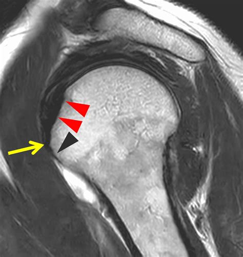 Subscapularis Tendon Tear Radsource