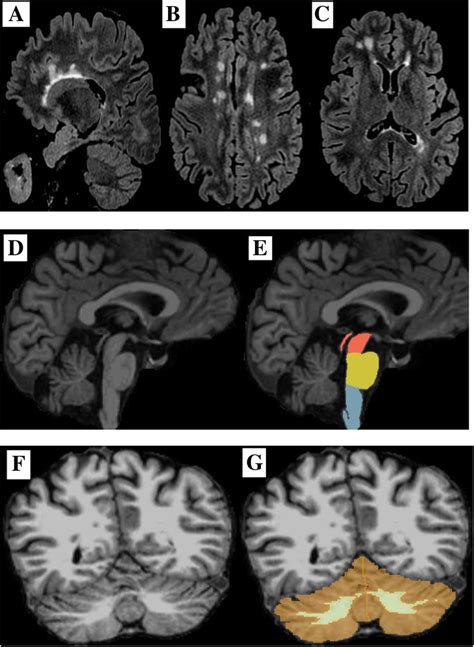 Relapsing Remitting Multiple Sclerosis Pacs