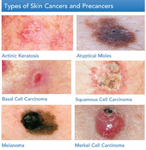 Types Of Actinic Keratosis