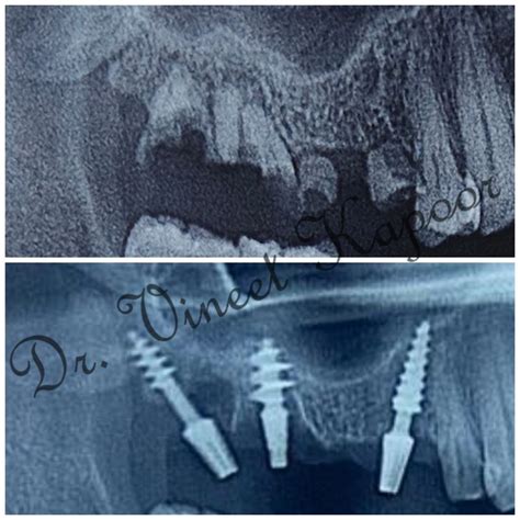 Corticobasal Implantology Dr Vineet Kapoor