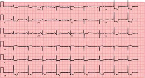 Initial Ecg Of St T Wave Abnormalities Leads Avr And V1 Show Download Scientific Diagram