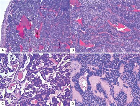 Histology Of The Tumour Lesion A The Lesion Is Capsulated And Download Scientific Diagram