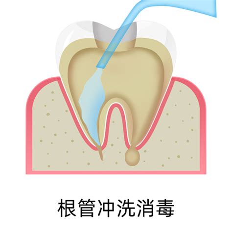 根管治疗过程 根管冲洗消毒
