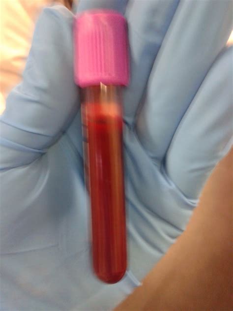 Analisis Hematologicos Indices Eritrocitarios