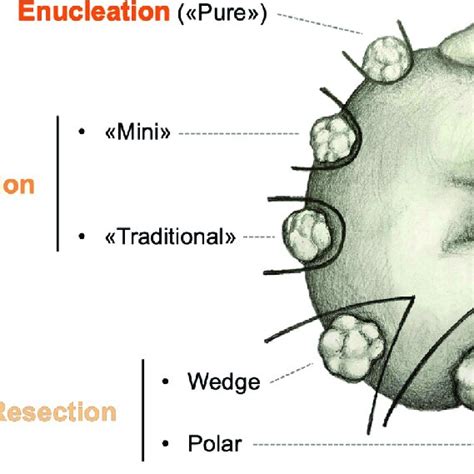 Sketch Of Resection Techniques During Robotic Partial Nephrectomy Download Scientific Diagram