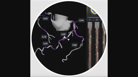 New Category I Cpt Code Issued For Ai Enabled Coronary Plaque Analysis