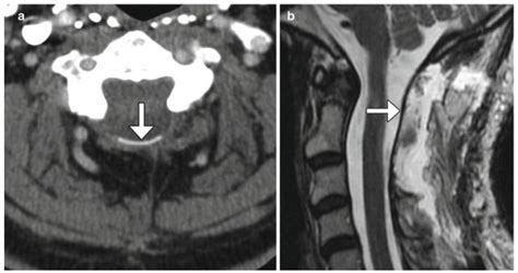 Laminectomy And Duraplasty Explained