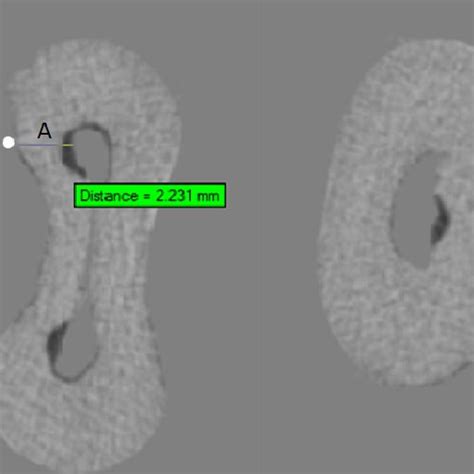 Representation Of The Dentin Thickness Measurement Before And After