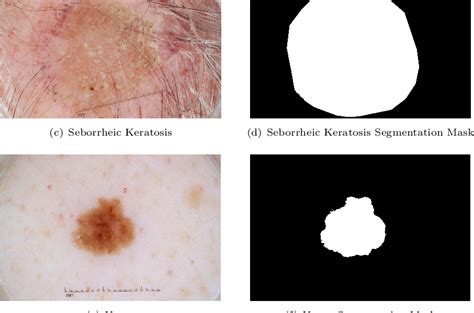 Figure 1 From Melanoma Recognition And Lesion Segmentation Using Multi Instance Learning