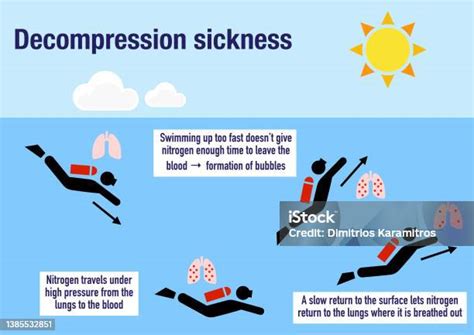 The Decompression Sickness Explained Stock Illustration Download