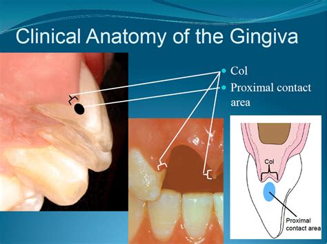 Interdental Gingiva