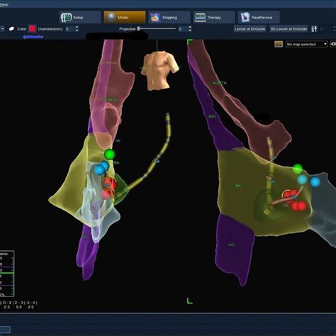 Simplified 3 Dimensional Electroanatomical Mapping The Right And Left Download Scientific