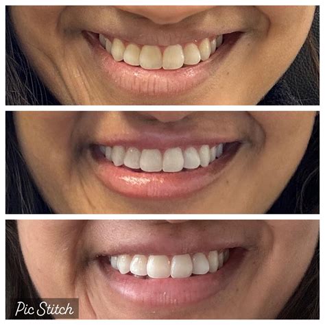 Masseter Gone Wrong Rbotoxsupportcommunity