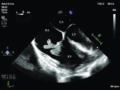 Midesophageal 4 Chamber View Focused On The Right Ventricle Rv In Download Scientific Diagram