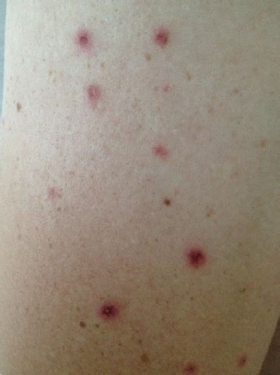 Erythematous Papular Rash Erythematous Papular Rash