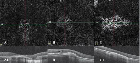 Phenotypes Of Nonactive Mcnv Using Octa А Glomerular В Regularized Download Scientific