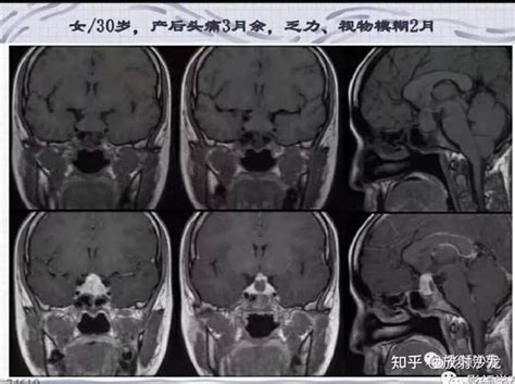 垂体解剖及常见病变影像学表现 知乎
