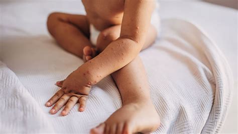 Rougeole Faute De Vaccination Des Dizaines De Millions Denfants En