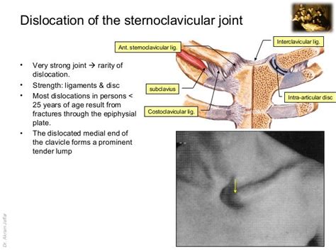 Imaging Anatomy Dislocation Of Sternoclavicular Joint