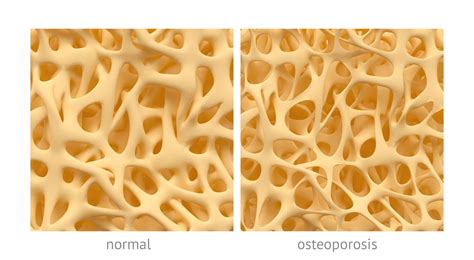 Osteoporoza Objawy Przyczyny Leczenie Medistore