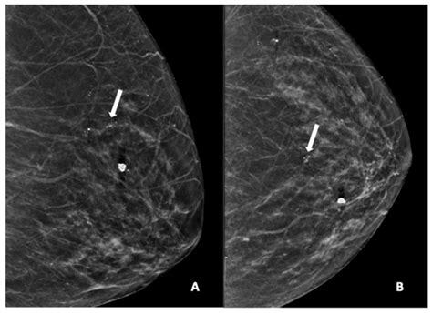 Association Between Microcalcification Patterns In Mammography And Breast Tumors In Comparison