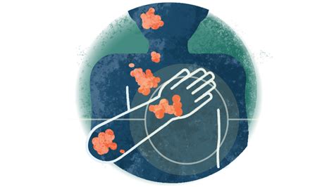 Atopic Dermatitis Medical Journeys Medpage Today