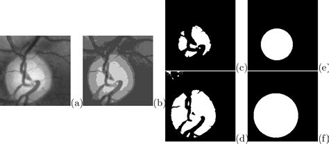 Figure 1 From Fully Automated Method For Glaucoma Screening Using Robust Optic Nerve Head