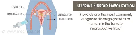 Uterine Fibroid Embolization Statistics Preparation Procedure Risks