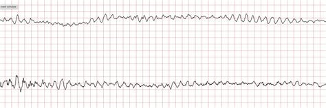 Sudden Cardiac Arrest Case 3 The Cardiovascular