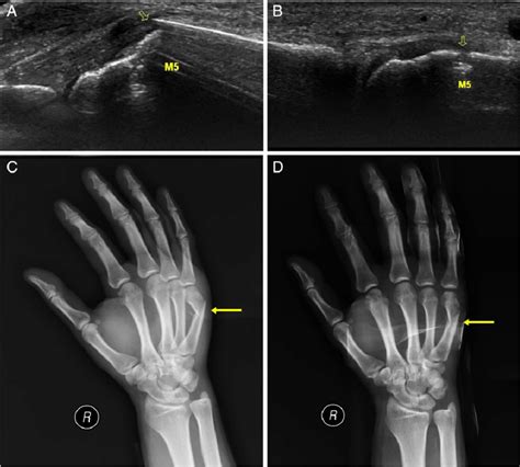 Fifth Metacarpal Shaft Fracture Rxharun