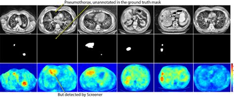 [论文审查] Screener Self Supervised Pathology Segmentation Model For 3d Medical Images