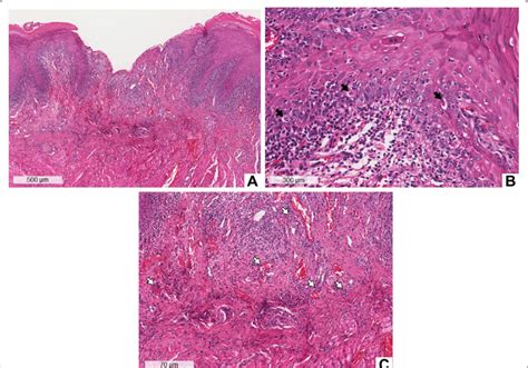 Histopathological Aspects Of Case 1 Biopsy Of The Lateral Border Of Download Scientific