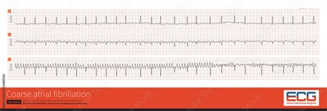 Sometimes Coarse Atrial Fibrillation Is Easily Misdiagnosed As Atrial Flutter But Their Shape