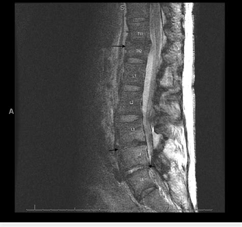 Lumbar Spine Mri Showing Chronic T12 Compression Deformity Mild Spinal Download Scientific