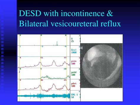 Ppt Urodynamics And Bladder Outlet Obstruction Powerpoint Presentation Id 1356300