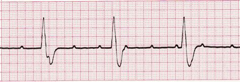 Third Degree Heart Block Ecg Interpretation 316