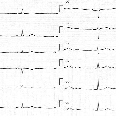 Automatic Measurement Of Absolute And Rate Corrected QT Interval Download Scientific Diagram