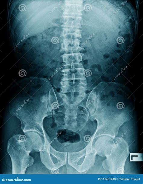 X Ray C Spine Or X Ray Image Of Cervical Spine Ap And Lateral View 168024922
