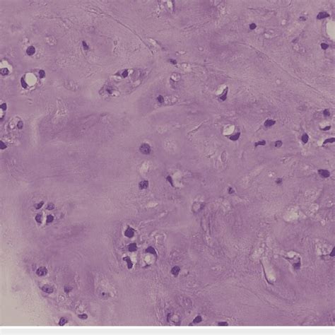 Histological Features Of The Low Grade Chondrosarcoma At Magnification Download Scientific