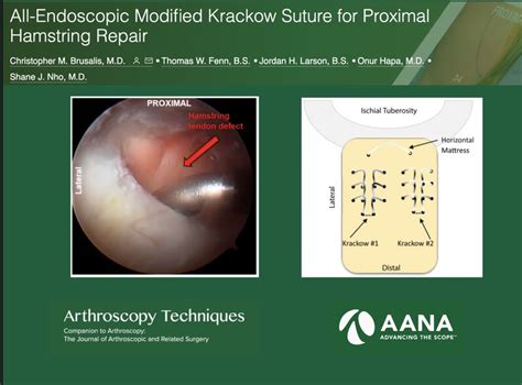 Arthroscopy Journals On Linkedin Endoscopic Repair Hamstring