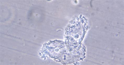 Bacterial Vaginosis A New Understanding Of Transmission Psychology Today Singapore