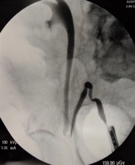 Retrograde Ureterogram Showing The Compressed Ureter Download