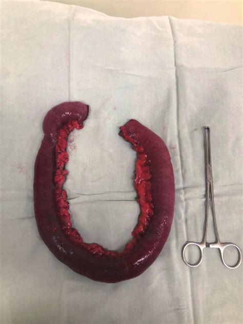 Portion Of The Resected Intestinal Loop Download Scientific Diagram