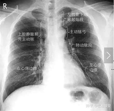 图解正常胸片怎么看 知乎