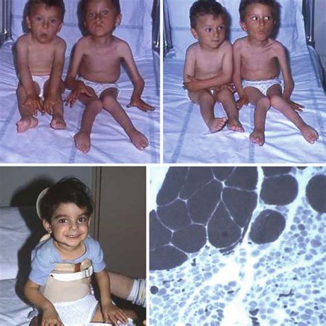 1 Werdnig Hoffmann Disease Type 2 In Two Brothers Patient 1 A B