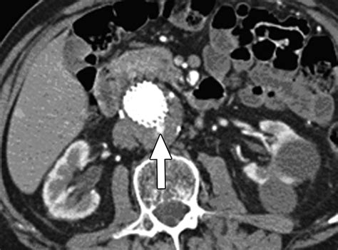 Clinical Significance Of Endoleak Detected On Follow Up Ct After