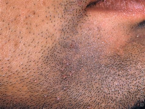 6 Pictures Of Warts And How To Treat Different Types Goodrx